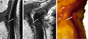 Extensor retinaculum of the wrist: gross anatomical correlation with MR ...