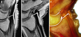 Extensor retinaculum of the wrist: gross anatomical correlation with MR ...