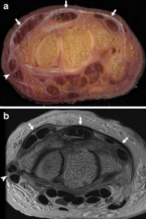 Extensor retinaculum of the wrist: gross anatomical correlation with MR ...