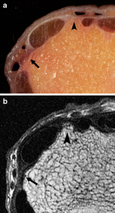 Extensor retinaculum of the wrist: gross anatomical correlation with MR ...