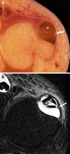 Extensor retinaculum of the wrist: gross anatomical correlation with MR ...