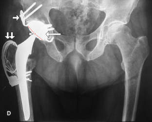 Intraprosthetic dislocation: a potentially serious complication of dual ...