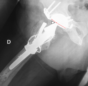 Intraprosthetic dislocation: a potentially serious complication of dual ...