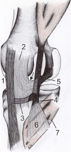 Distal insertions of the semimembranosus tendon: MR imaging with ...