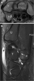 Pisotriquetral joint disorders: an under-recognized cause of ulnar side ...