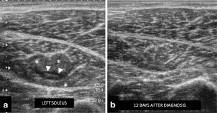 Soleus muscle injury: sensitivity of ultrasound patterns | SpringerLink