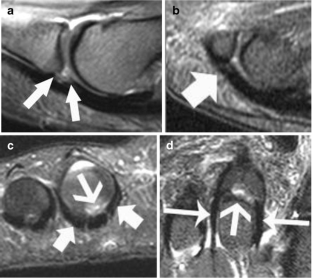 MRI of lesser metatarsophalangeal joint plantar plate tears and ...