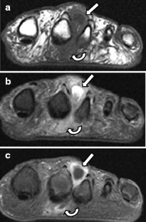 MRI of lesser metatarsophalangeal joint plantar plate tears and ...