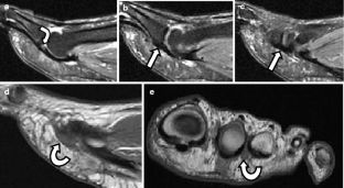 MRI of lesser metatarsophalangeal joint plantar plate tears and ...