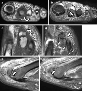 MRI of lesser metatarsophalangeal joint plantar plate tears and ...