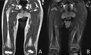 MRI findings in pediatric patients with scurvy | SpringerLink