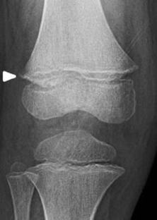 MRI findings in pediatric patients with scurvy | SpringerLink