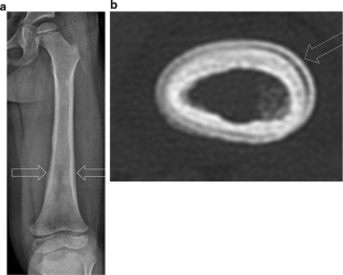 Periosteum: Characteristic imaging findings with emphasis on radiologic ...