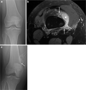 Periosteum: Characteristic imaging findings with emphasis on radiologic ...