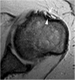 The aponeurotic expansion of the supraspinatus tendon: anatomy and ...