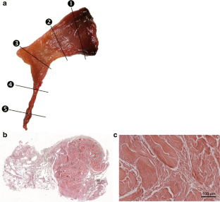 The aponeurotic expansion of the supraspinatus tendon: anatomy and ...