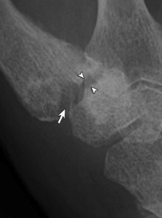 Imaging and management of thumb carpometacarpal joint osteoarthritis ...