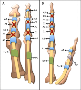 Magnetic resonance imaging of the pulleys of the flexor tendons of the ...