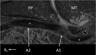 Magnetic resonance imaging of the pulleys of the flexor tendons of the ...