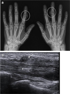 Benign soft-tissue lesions of the fingers: radiopathological ...