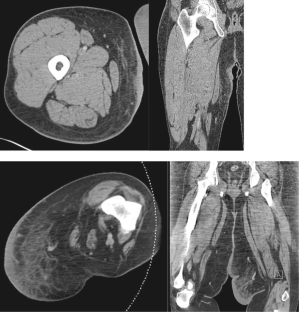 Imaging findings of adiposis dolorosa vs. massive localized lymphedema ...