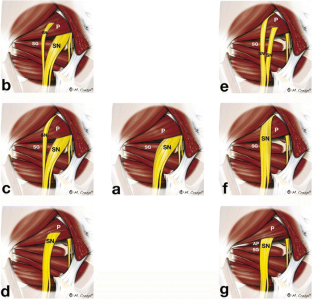 Deep gluteal syndrome: anatomy, imaging, and management of sciatic ...