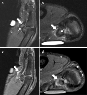 MR imaging findings of trigger thumb | SpringerLink