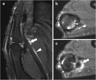 MR imaging findings of trigger thumb | SpringerLink