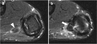 MR imaging findings of trigger thumb | SpringerLink