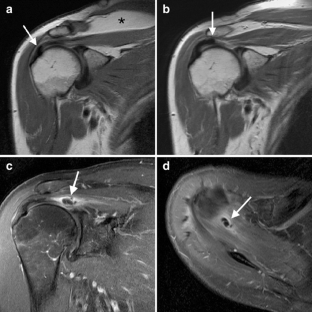 Intramuscular migration of calcium hydroxyapatite crystal deposits ...
