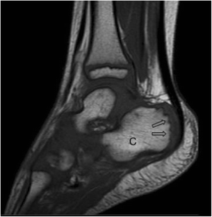 Normal skeletal development and imaging pitfalls of the calcaneal ...