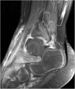 Normal skeletal development and imaging pitfalls of the calcaneal ...