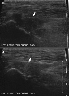 Sonographic evaluation of athletic pubalgia | SpringerLink