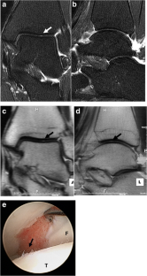 MRI of the anterior talofibular ligament, talar cartilage and os ...