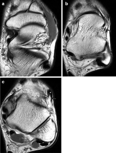 The frondiform ligament and pseudotenosynovitis of the extensor ...