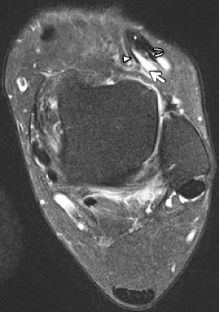 The frondiform ligament and pseudotenosynovitis of the extensor ...