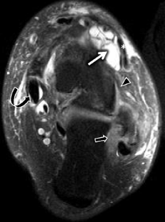 The frondiform ligament and pseudotenosynovitis of the extensor ...