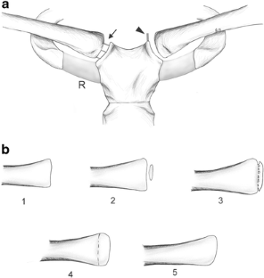 High-resolution CT of the sternoclavicular joint and first ...