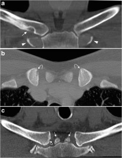 High-resolution CT of the sternoclavicular joint and first ...