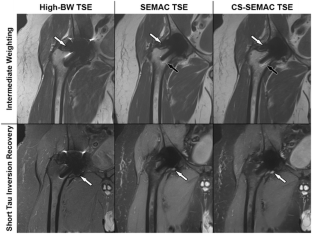 Advanced metal artifact reduction MRI of metal-on-metal hip resurfacing ...