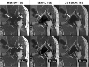 Advanced metal artifact reduction MRI of metal-on-metal hip resurfacing ...