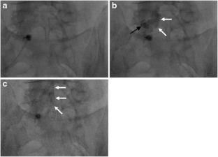 Long-term outcomes of percutaneous lumbar facet synovial cyst rupture ...