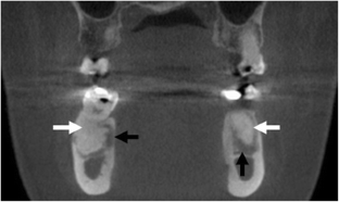 Florid cemento-osseous dysplasia: review of an uncommon fibro-osseous ...
