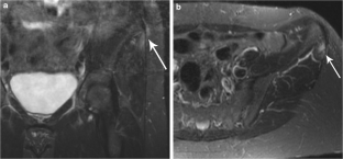 The iliotibial tract: imaging, anatomy, injuries, and other pathology ...