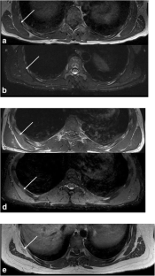 MR neurography (MRN) of the long thoracic nerve: retrospective review ...