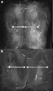 MR neurography (MRN) of the long thoracic nerve: retrospective review ...