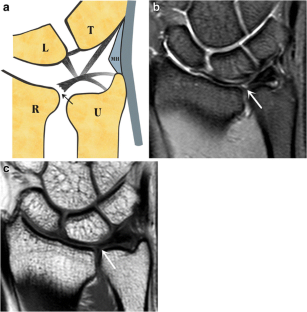 High-resolution 3-T MRI of the triangular fibrocartilage complex in the ...