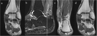 Assessment of hindfoot alignment using MRI and standing hindfoot ...