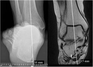 Assessment of hindfoot alignment using MRI and standing hindfoot ...