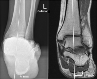 Assessment of hindfoot alignment using MRI and standing hindfoot ...